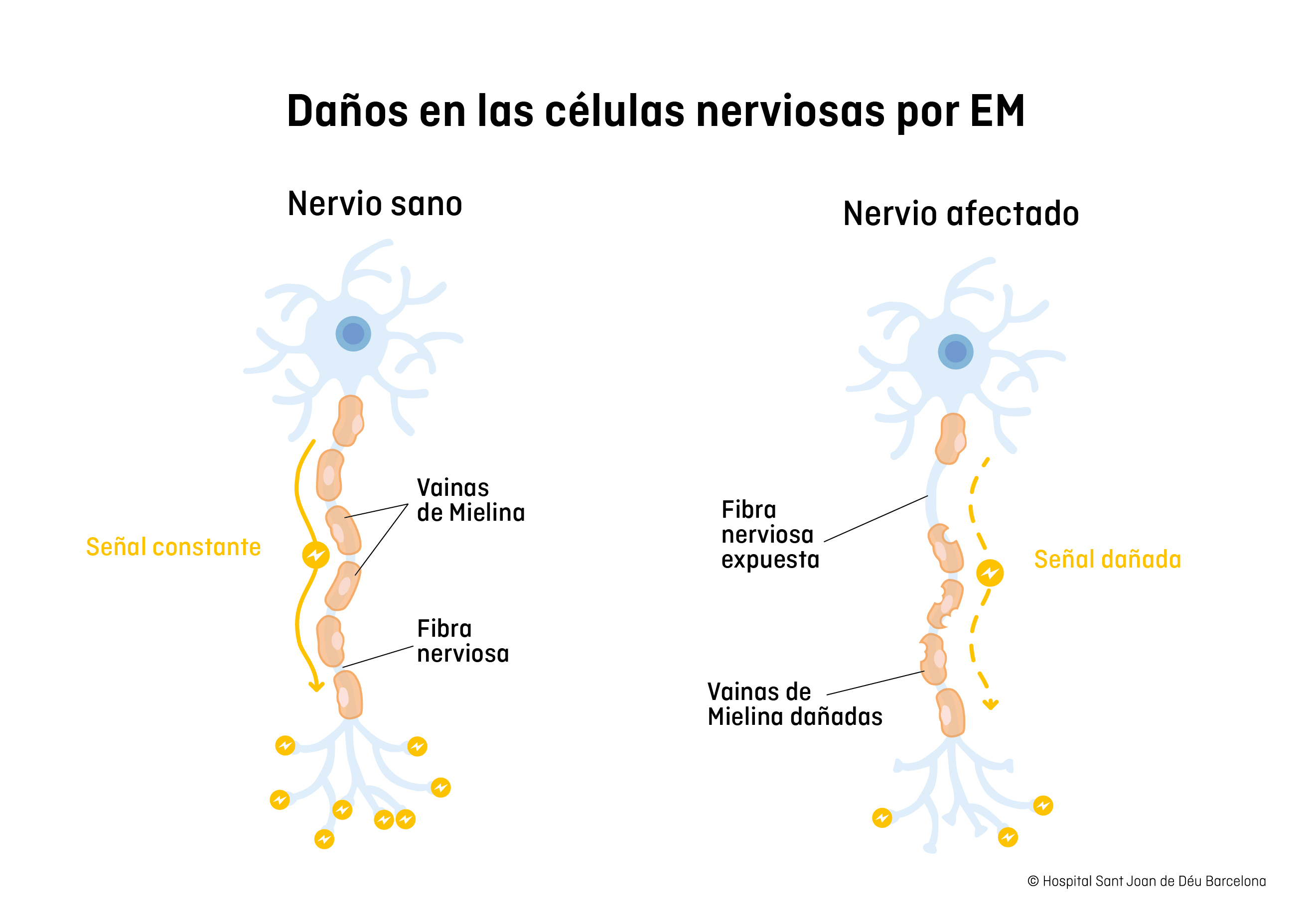 Esclerosis múltiple | Escola Salut SJD