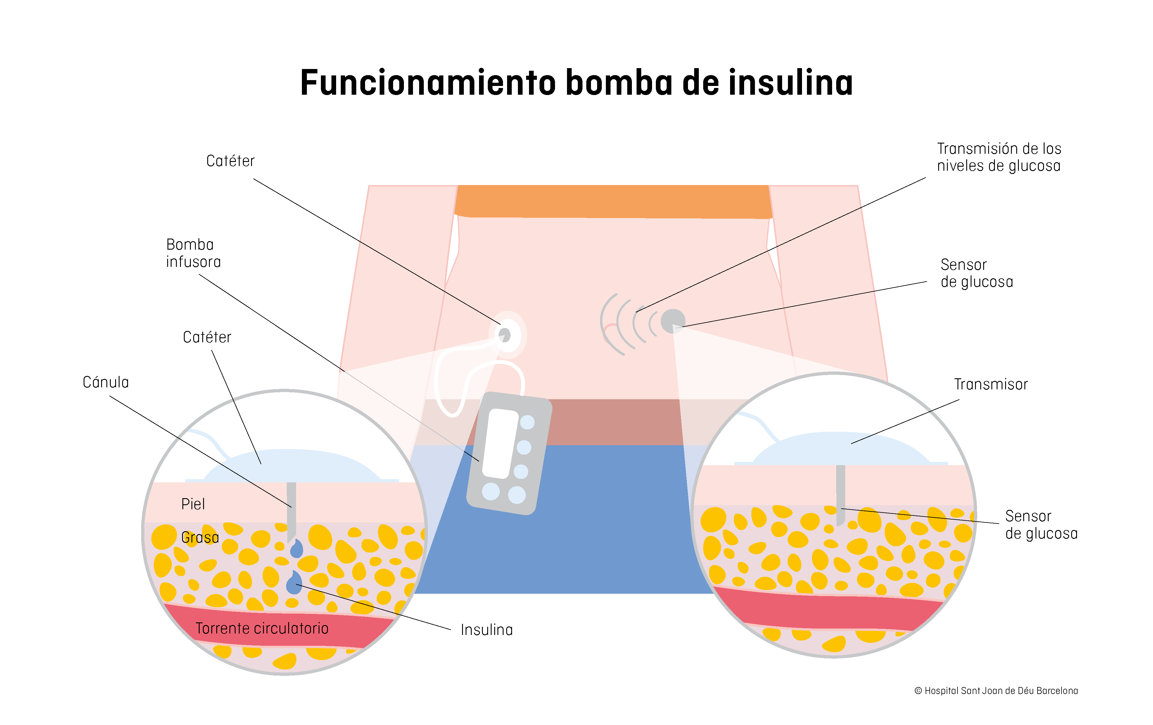 Páncreas artificial o bomba de insulina | Escola de Salut SJD