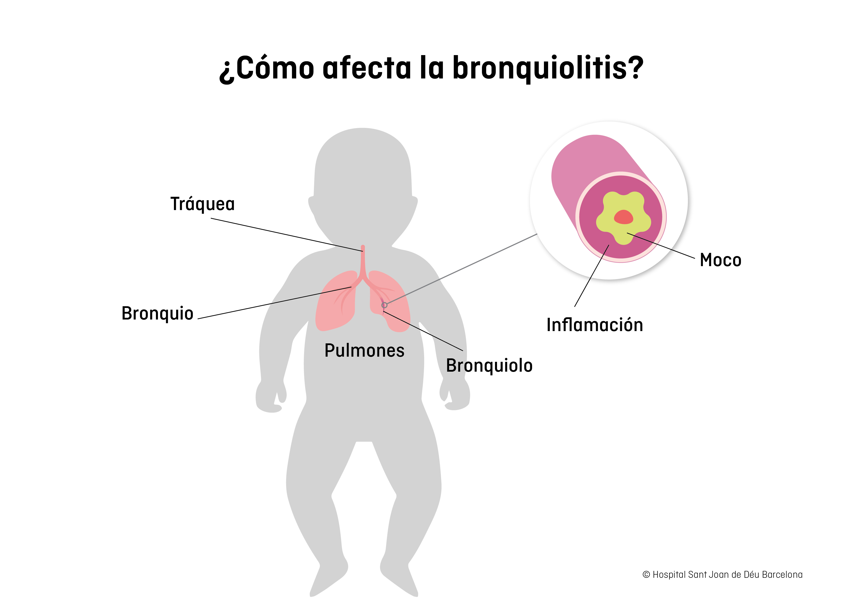 Bronquiolitis | Escola Salut SJD