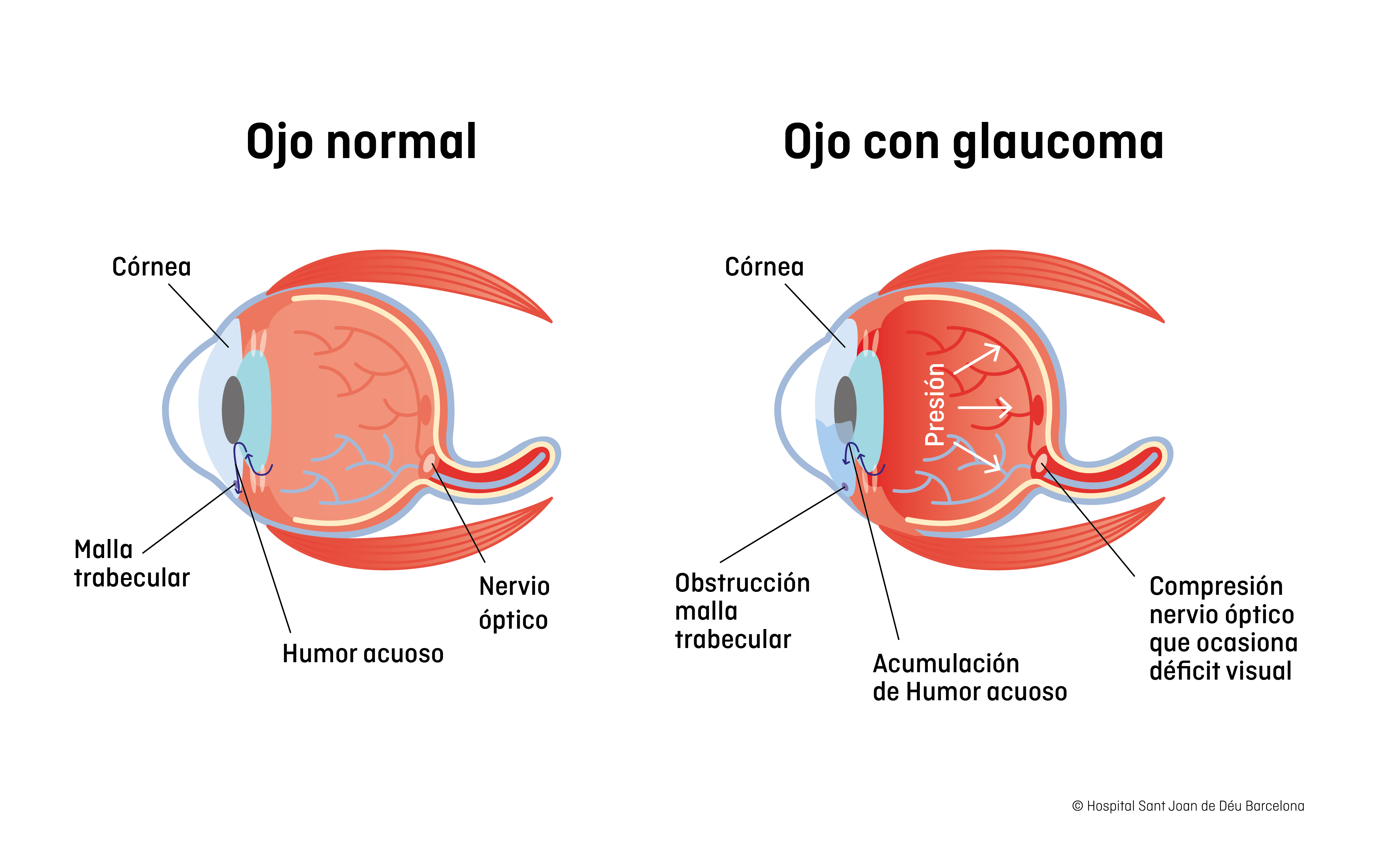 Glaucoma pediátrico | Escola de Salut SJD
