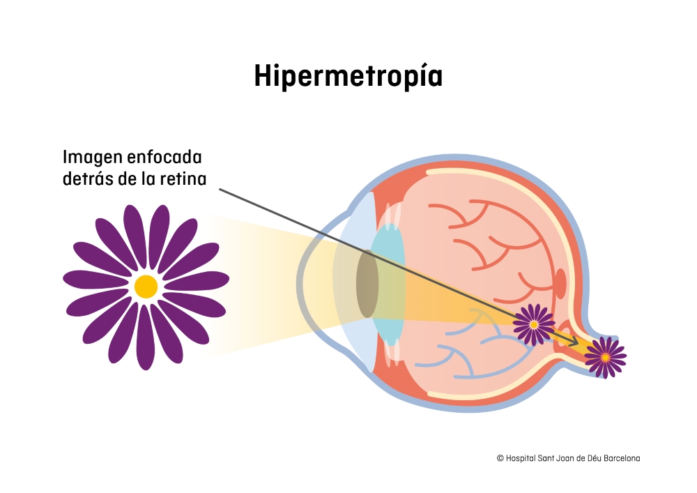 Hipermetropía | Escola de Salut SJD